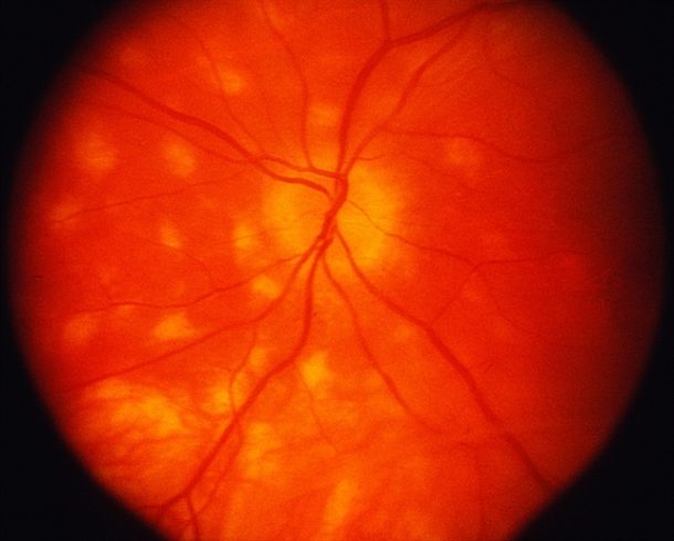 Birdshot Retinochoroidopathy - Ophthalmology Education blog ...