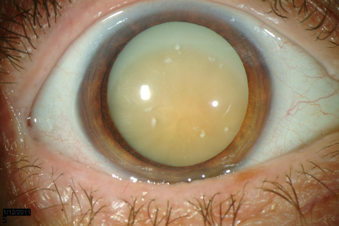 Morgagnian Cataract Ophthalmology Education Educate choroida morgagnian-cataract-ophthalmology-education-educate-choroida