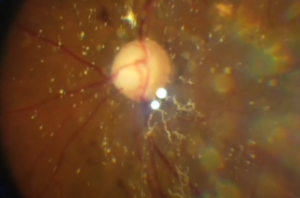 Synchysis Scintillans: what is it? - Ophthalmology Education