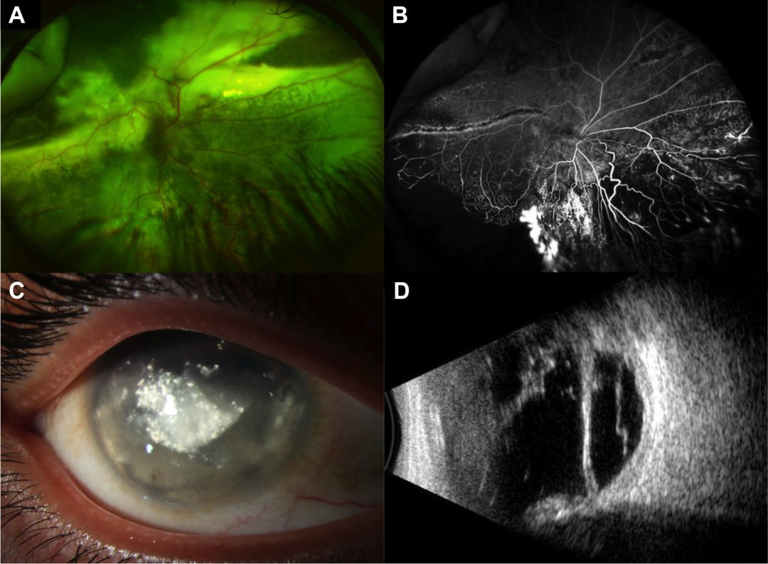 Synchysis Scintillans: what is it? - Ophthalmology Education