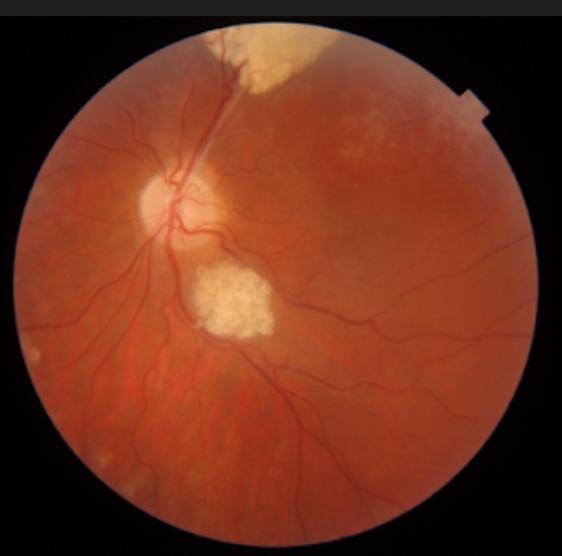 Retinal astrocytic hamartoma: case study, description & more