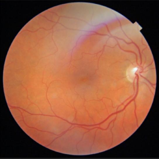 Cystoid Macular Edema All What You Should Know Blog Cystoid Macular Edema All What You Should Know Blog