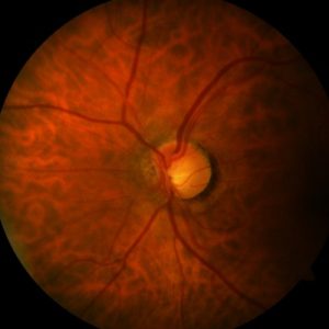 What is Tilted Disc Syndrome? (answered) - Ophthalmology Education