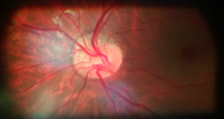 What is Tilted Disc Syndrome? (answered) - Ophthalmology Education