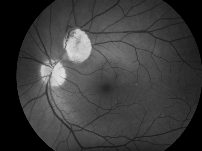 Retinal Hamartoma Tuberous Sclerosis