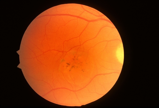 Pigment Epithelial detachment: full study - Ophthalmology Education