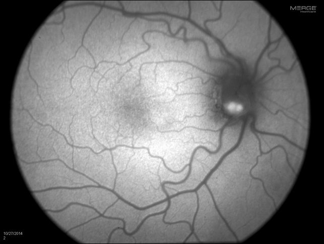 Optic disc drusens: ALL YOU NEED TO KNOW - Ophthalmology Education