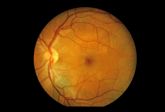 solar retinopathy: An in-depth look - Ophthalmology Education