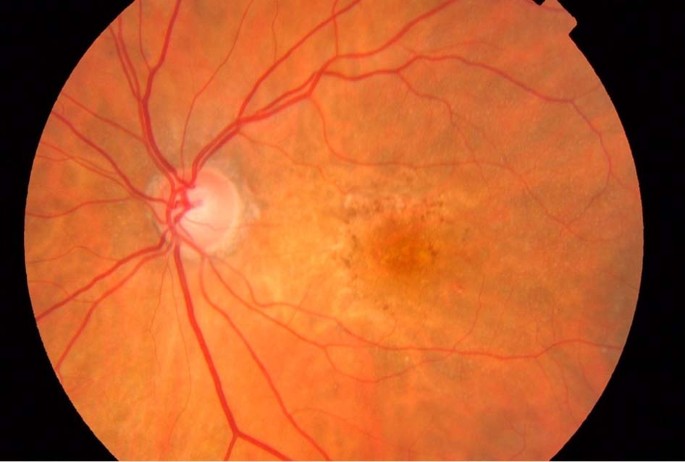 What Is Geographic Atrophy Answer Inside Ophthalmology Education