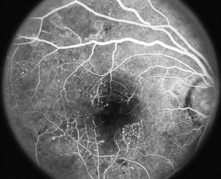 Diabetic Macular ischemia: disease entity, diagnosis and management