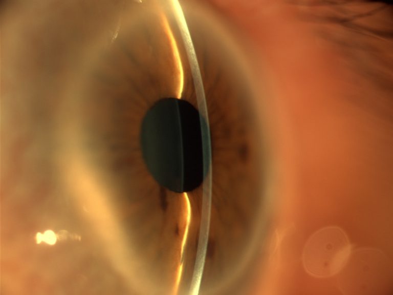 Cornea Plana: A Practical Guide for Ophthalmologists
