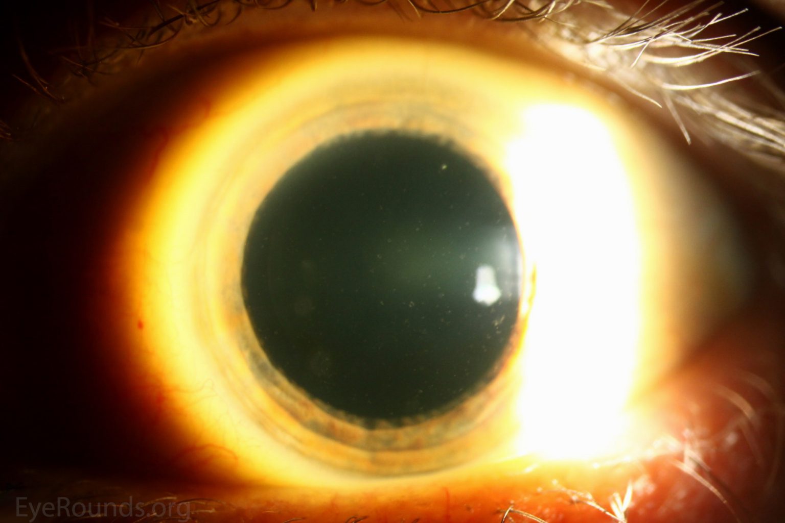 Fleck Corneal Dystrophy: full report - Ophthalmology Education