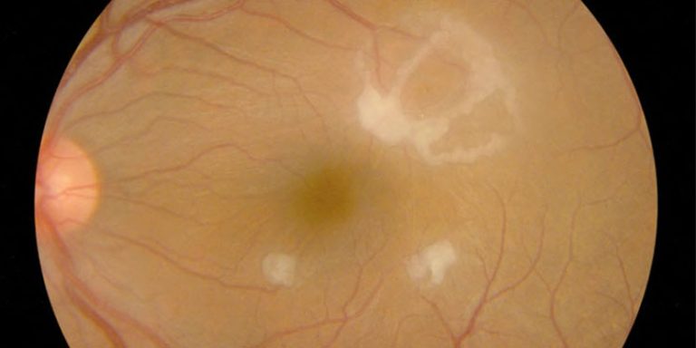 Ocular Candidiasis: Sight-Threatening Condition - Ophthalmology Education