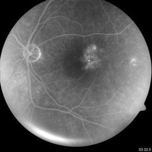Macular telangiectasia (Mac Tel): Intensive Research