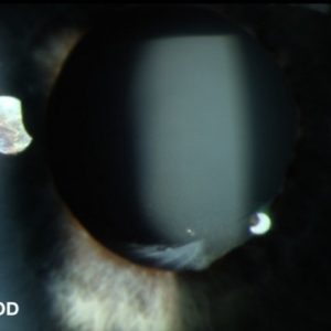 Capsular Bag Distension Syndrome (CBDS):full study