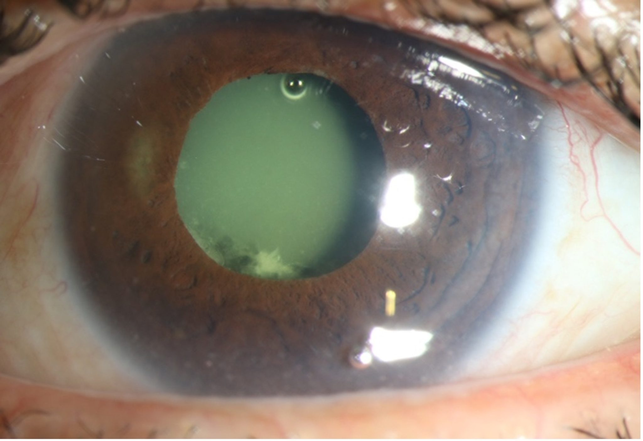 Capsular Bag Distension Syndrome (CBDS):full study