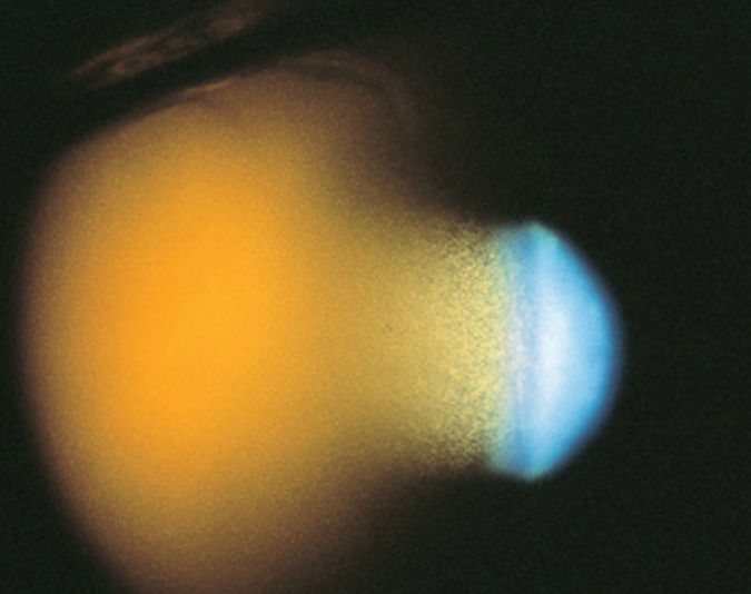 Ghost Cell Glaucoma: A Comprehensive Review Ophthalmology Education