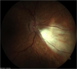 Myelinated Retinal Nerve Fiber Layer (MRNF): What is it?!
