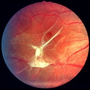 Epiretinal Membrane (ERM): How serious is it?! - Ophthalmology Education