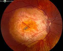 Sclerochoroidal Calcification: Unveiling this Enigmatic Eye Condition