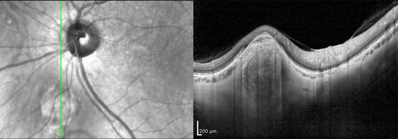Focal Scleral Nodule (FSN): The Eye's Enigmatic Visitor