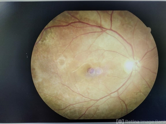 Diffuse Unilateral Subacute Neuroretinitis (DUSN): Case study report