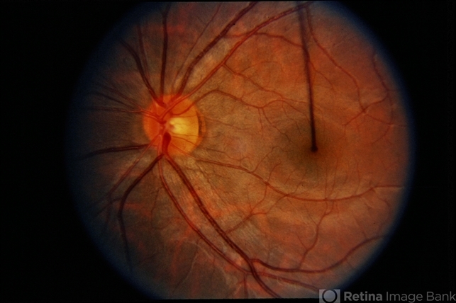 Diffuse Unilateral Subacute Neuroretinitis (DUSN): Case study report