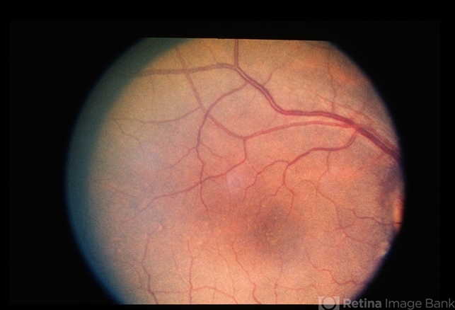 Diffuse Unilateral Subacute Neuroretinitis (DUSN): Case study report