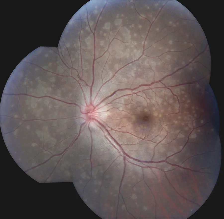 Multiple Evanescent White Dot Syndrome (MEWDS) - Ophthalmology Education