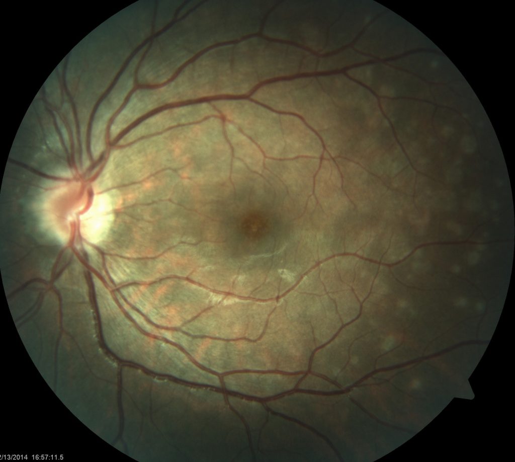 Multiple Evanescent White Dot Syndrome (MEWDS) - Ophthalmology Education