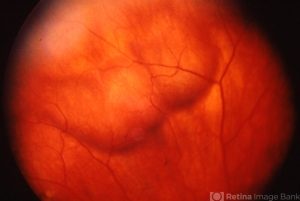 Vortex Vein Varix (VVV): all you need to know - Ophthalmology Education