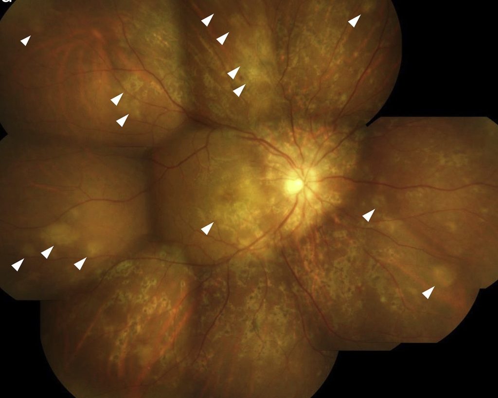 Relentless Placoid Chorioretinitis (RPC): from A to Z