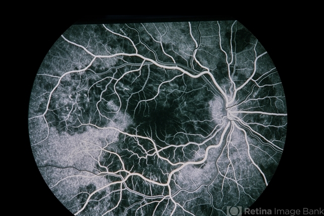 Acute Posterior Multifocal Placoid Pigment Epitheliopathy (APMPPE)