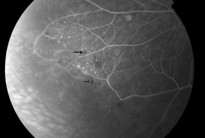 Retinal capillary nonperfusion: a full study | Ophthalmology Education