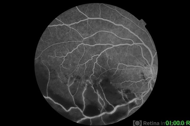 Retinal capillary nonperfusion: a full study | Ophthalmology Education