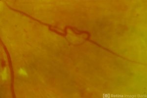 Venous Loop: What is it?! - Ophthalmology Education