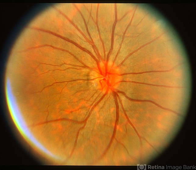 Venous Loop: What is it?! - Ophthalmology Education