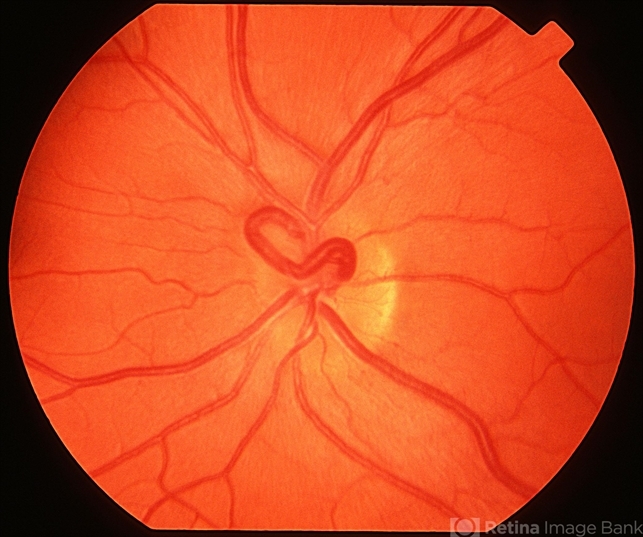 Venous Loop: What is it?! - Ophthalmology Education