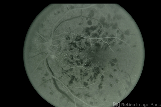 Venous Stasis Retinopathy Vitreous Hemorrhage: From One Medical