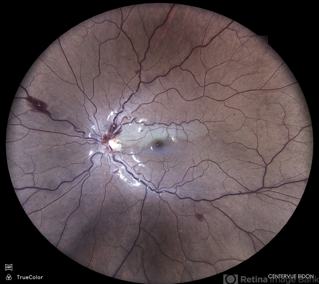 Venous Stasis Retinopathy Vitreous Hemorrhage: From One Medical