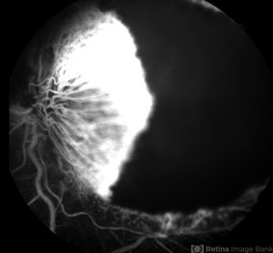 Sea Fan Neovascular Frond: From A to Z - Ophthalmology Education
