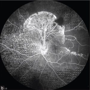 Sea Fan Neovascular Frond: From A to Z - Ophthalmology Education