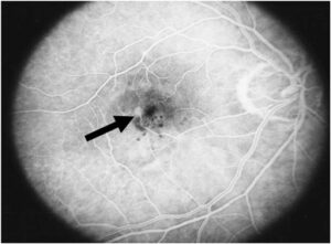 Retinal Angiomatous Proliferation (RAP): Management Strategies ...
