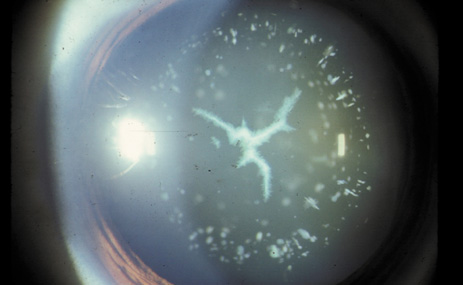 Snowflake cataract - Ophthalmology Education