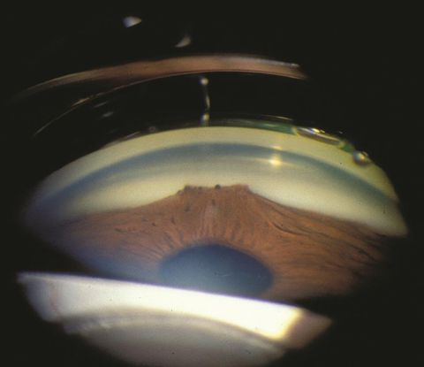 Acquired Ectropion Uveae (AEU) in A 57-year-old female - Ophthalmology ...