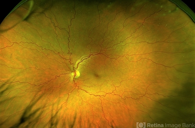 Retinal Vascular Tortuosity: what is it? - Ophthalmology Education