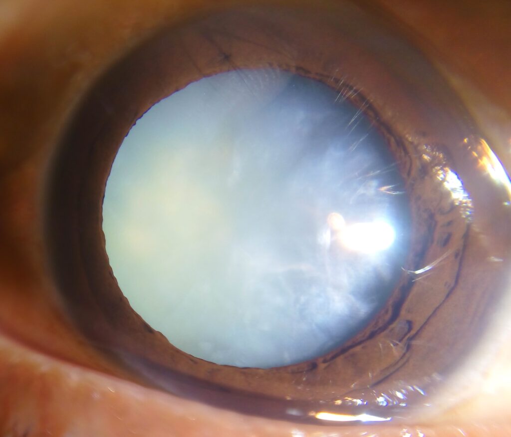 Snowflake cataract - Ophthalmology Education