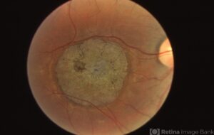 Central Areolar Choroidal Dystrophy (CACD): A full Overview