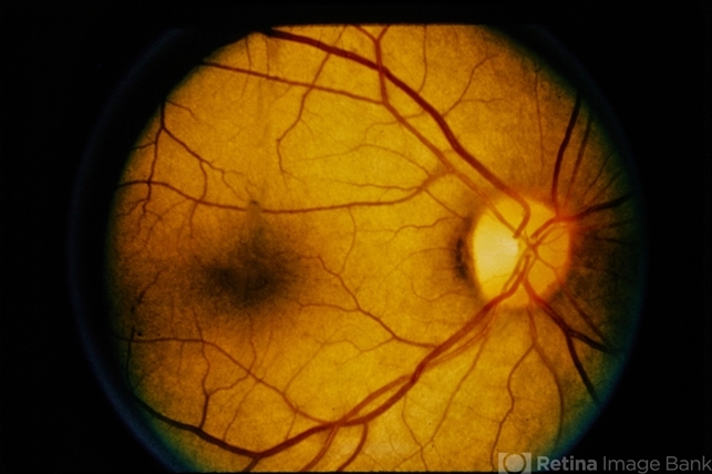 Oguchi disease: Degenerative Retinal Disease - Ophthalmology Education