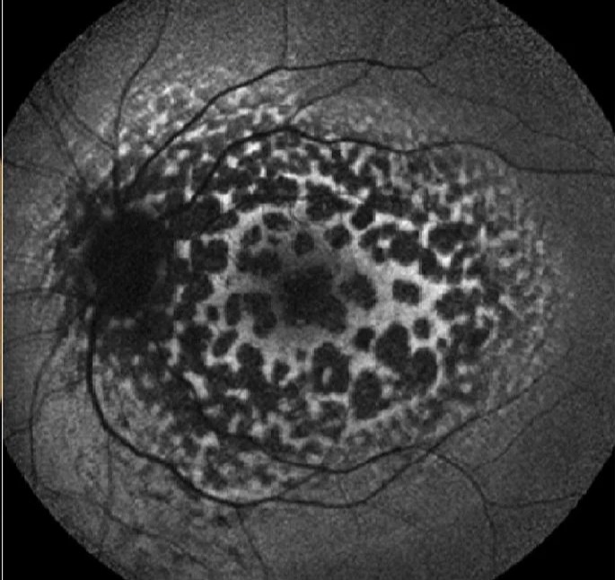 Leopard Chorioretinopathy: case study, diagnosis and management ...